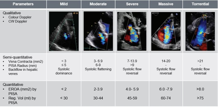 Tricuspid regurgitation – Part 1: evaluation and risk stratification